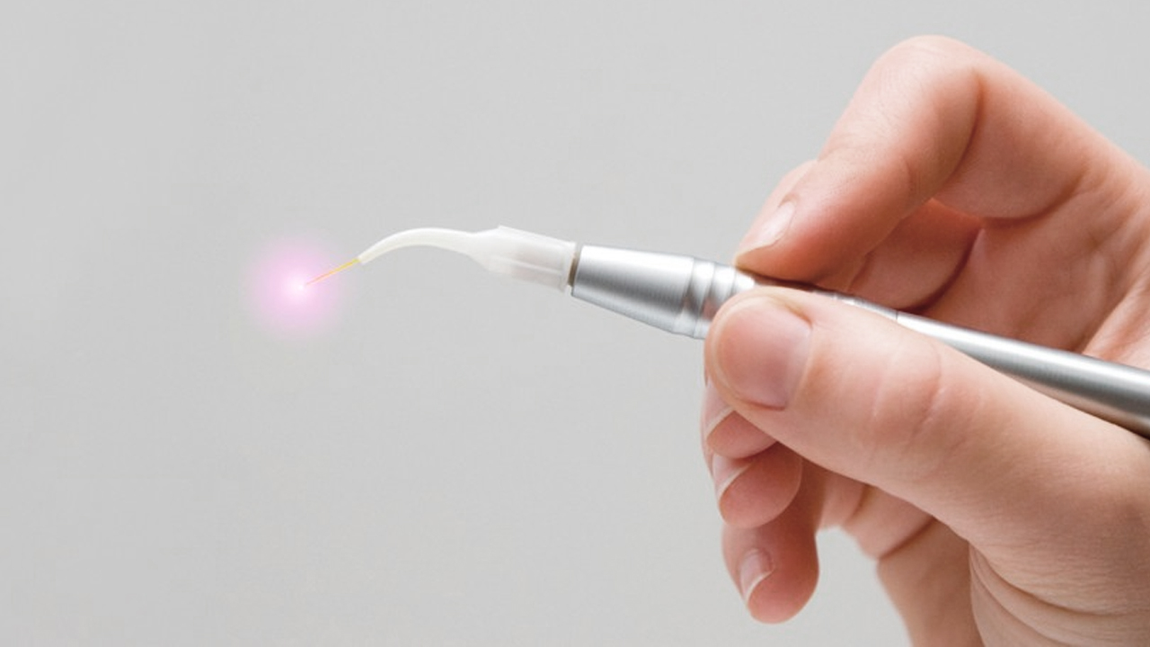 ¿Qué es la fotobiomodulación dental y para qué sirve?